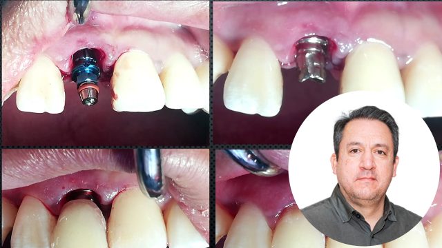 🇪🇸 Técnicas de regeneración de la papila | BTI Channel