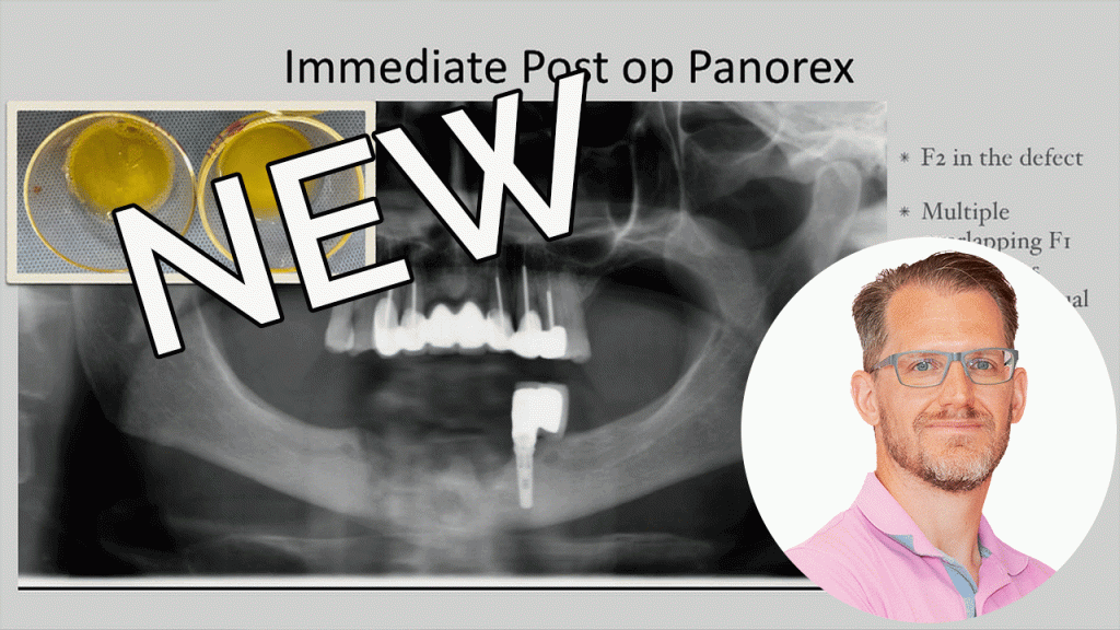 Application of PRGF - ENDORET®in dentistry › BTI Channel