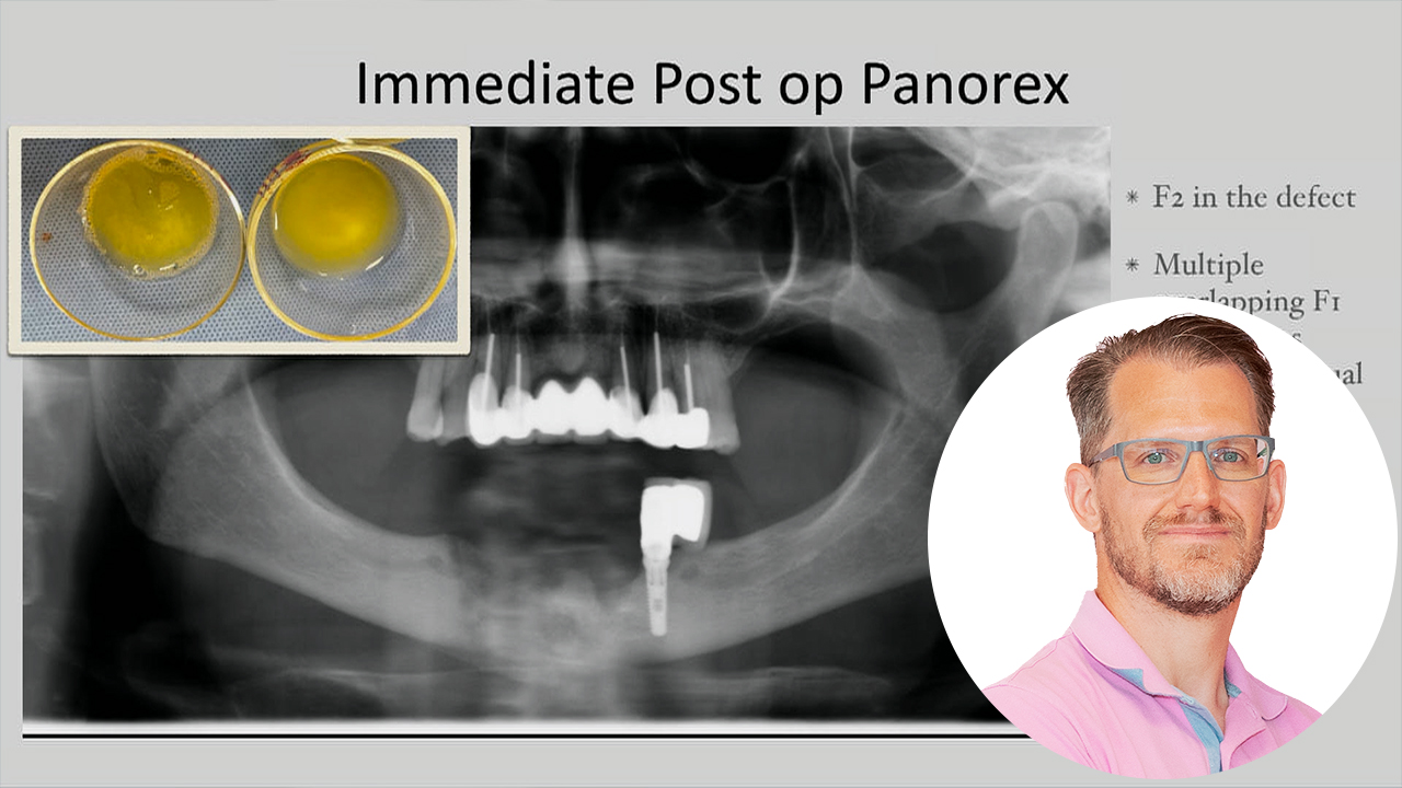 PRGF in the treatment of non-neoplastic pathology